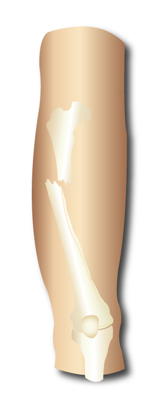 Bone fractures - AOA | Australian Orthopaedic Association